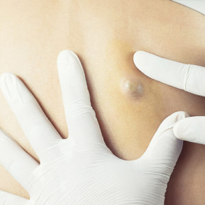 Cyst Treatment Sacramento & Roseville, CA | Dr. Scott Hearth